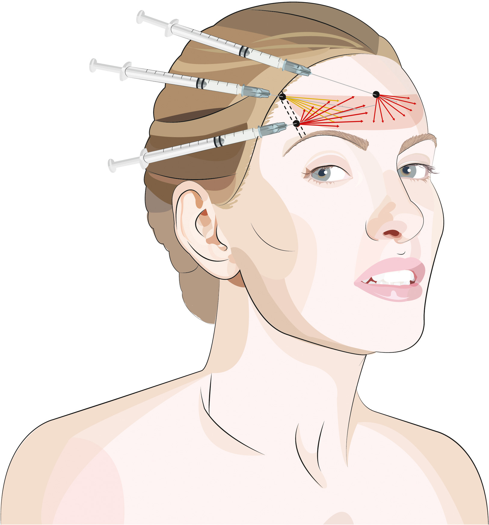 What Are the Different Types of Fillers And Their Benefits - Revive Clinic