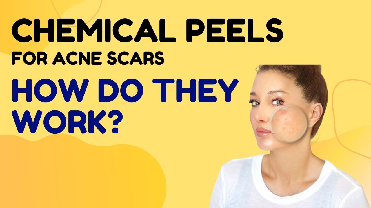 Chemical Peels For Acne Scars: Do They Work? - Revive Clinic
