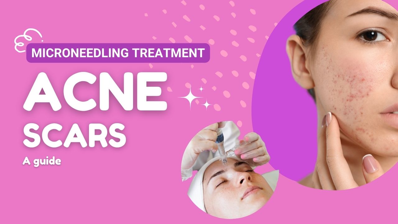 Getting a Microneedling Treatment for Acne Scars: A Guide - Revive Clinic