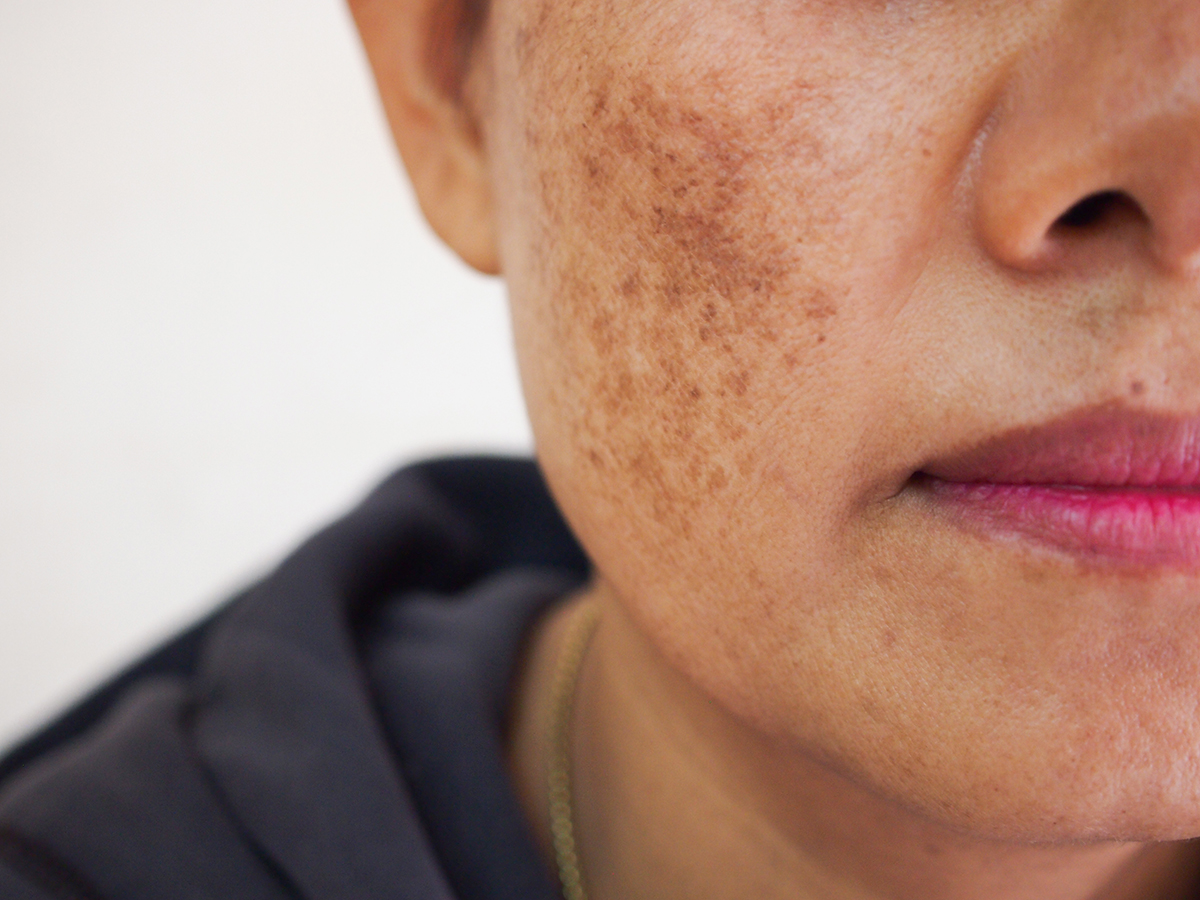 Skin Pigmentation: Types, Causes, Treatments and Prevention - Revive Clinic