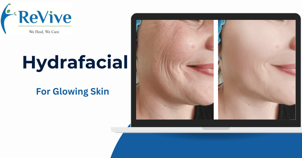 Why Everyone’s Talking About Hydrafacial for Glowing Skin - Revive Clinic